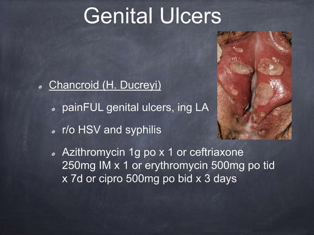 KHMH Obs gyn infections PID ulcers STDs vaginitis.ppt | Sexual ...