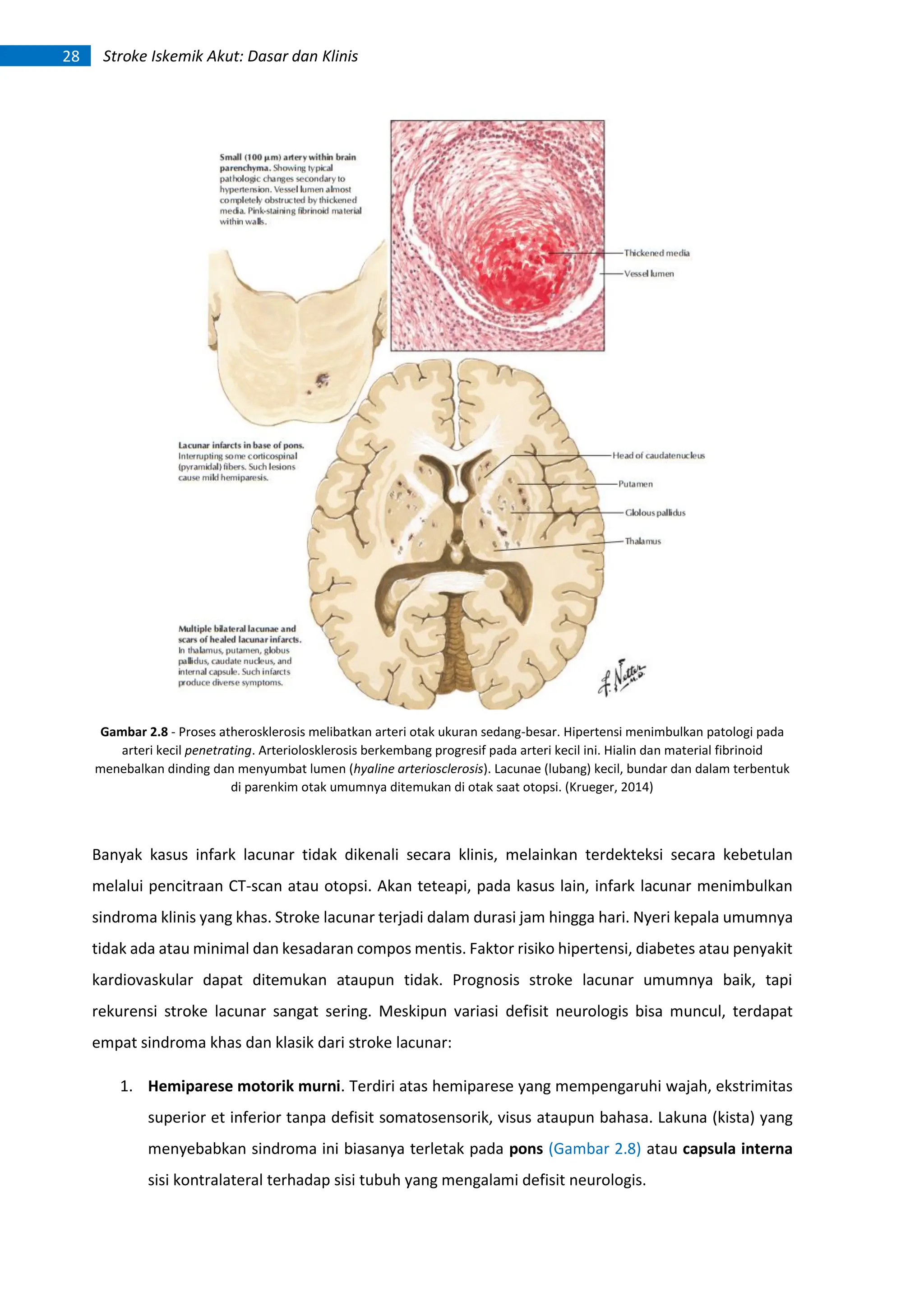 buku tentang terbaru stroke iskemik akut ebook.pdf