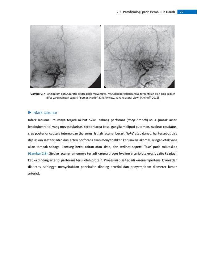buku tentang terbaru stroke iskemik akut ebook.pdf