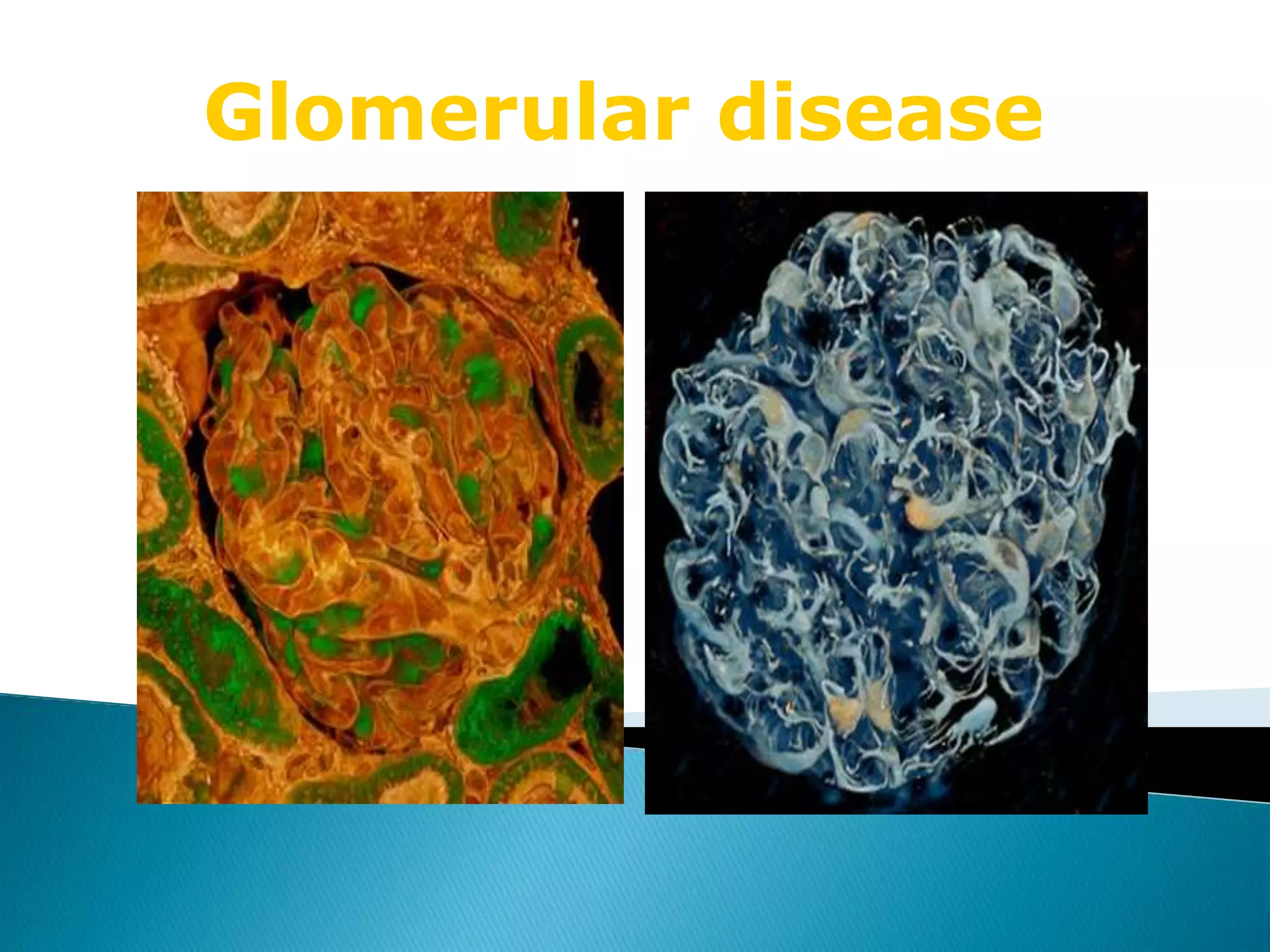 glomerular disease | PPTX