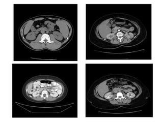 Imaging Anatomy of UT and some common Pathologies differences as a ...