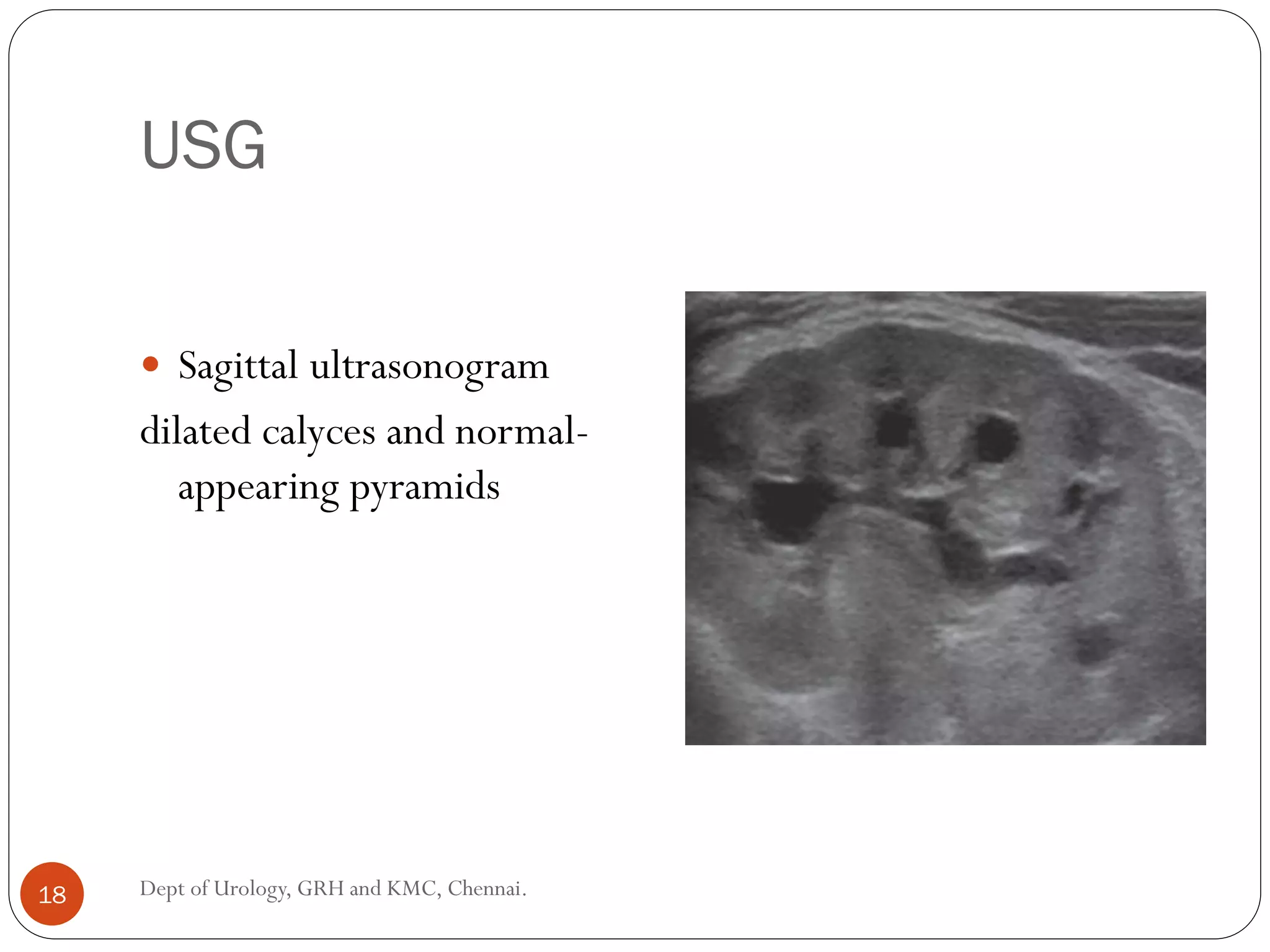 ANOMALY OF COLLECTING DUCT | PDF