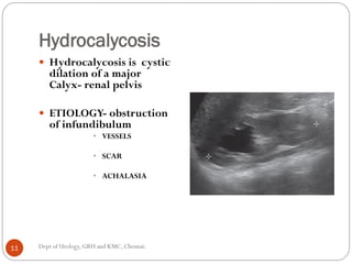 ANOMALY OF COLLECTING DUCT | PPT
