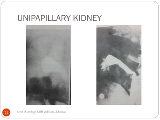 ANOMALY OF COLLECTING DUCT | PDF