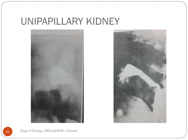 ANOMALY OF COLLECTING DUCT | PDF