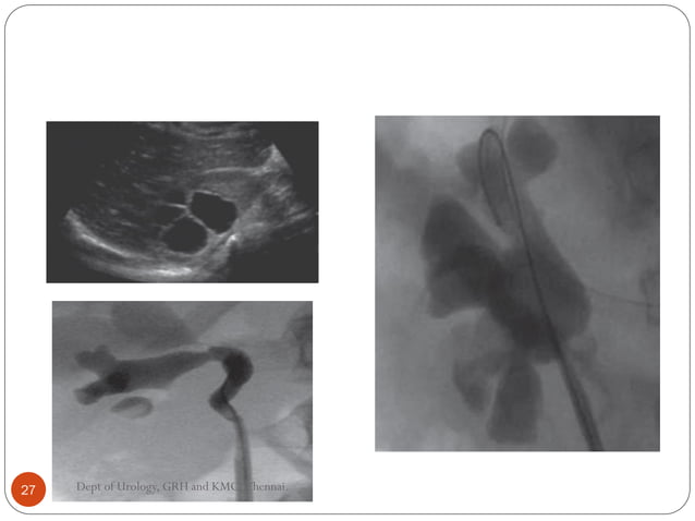 ANOMALY OF COLLECTING DUCT | PDF
