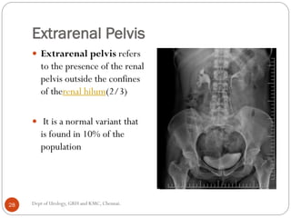 Extrarenal Pelvis