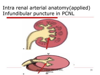 Infundibular In Kidney