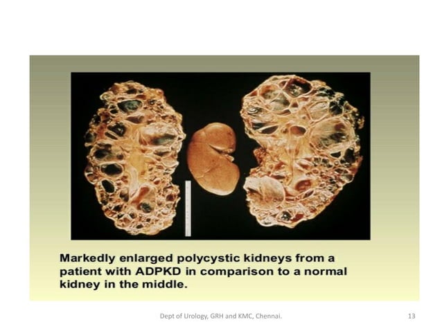 RENAL CYSTIC DISEASE | PDF | Genetics | Science