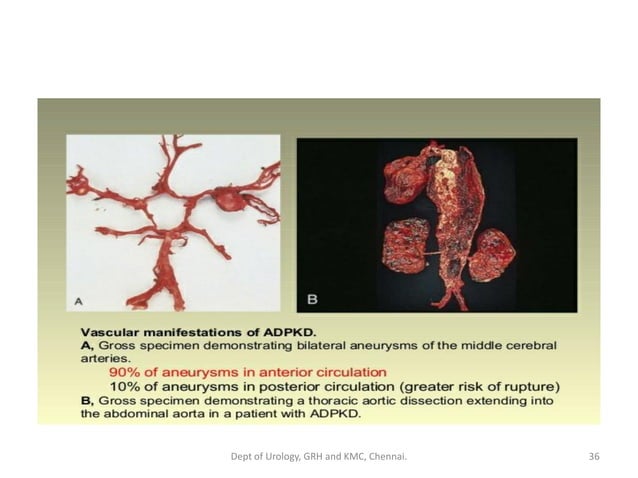 RENAL CYSTIC DISEASE | PDF | Genetics | Science