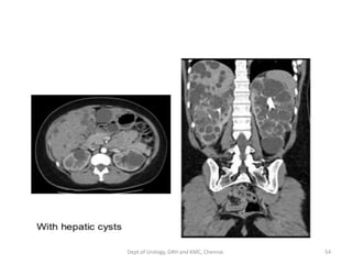 RENAL CYSTIC DISEASE | PDF