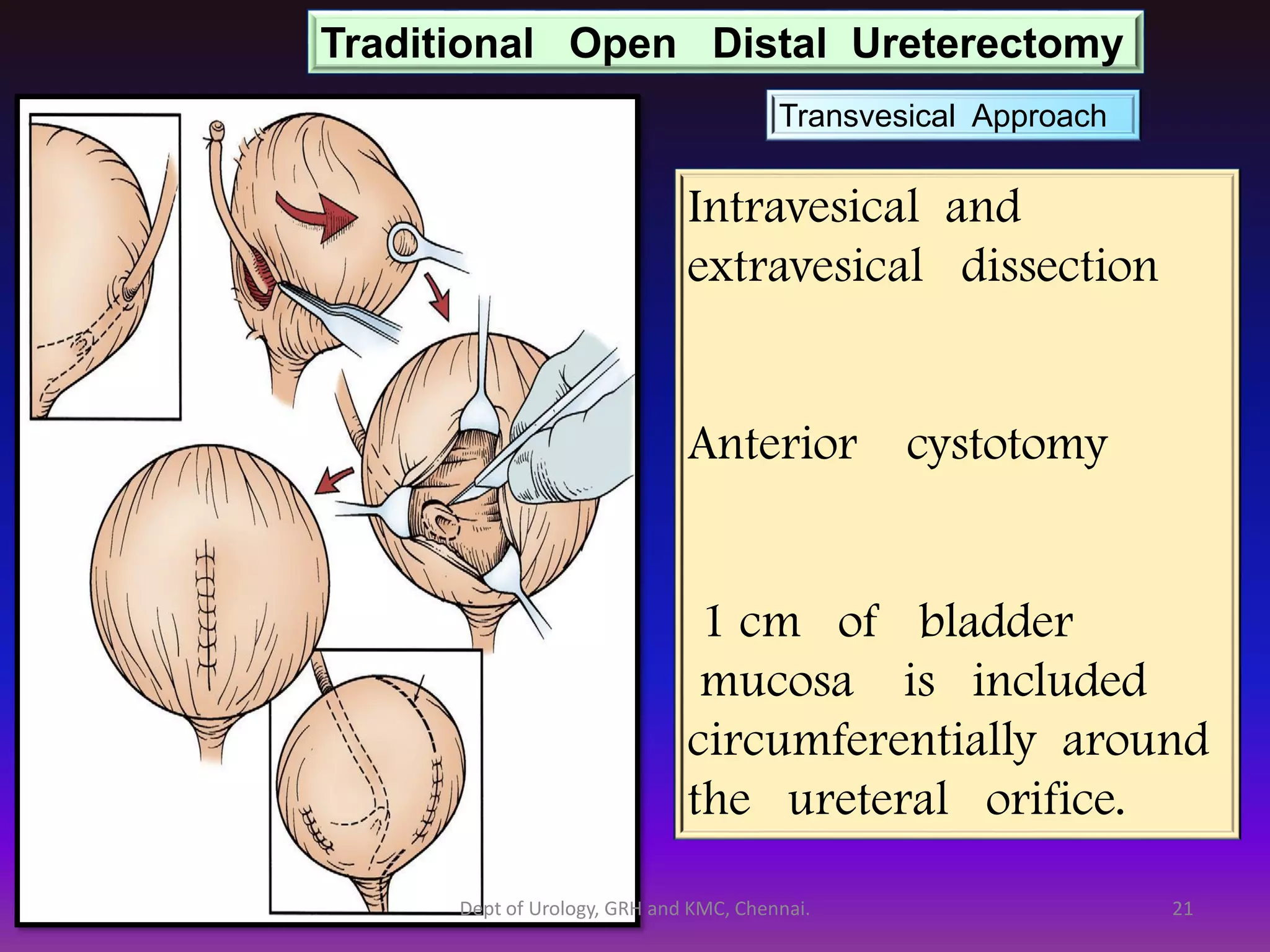Upper urinary tract - Urothelial cell carcinoma | PDF