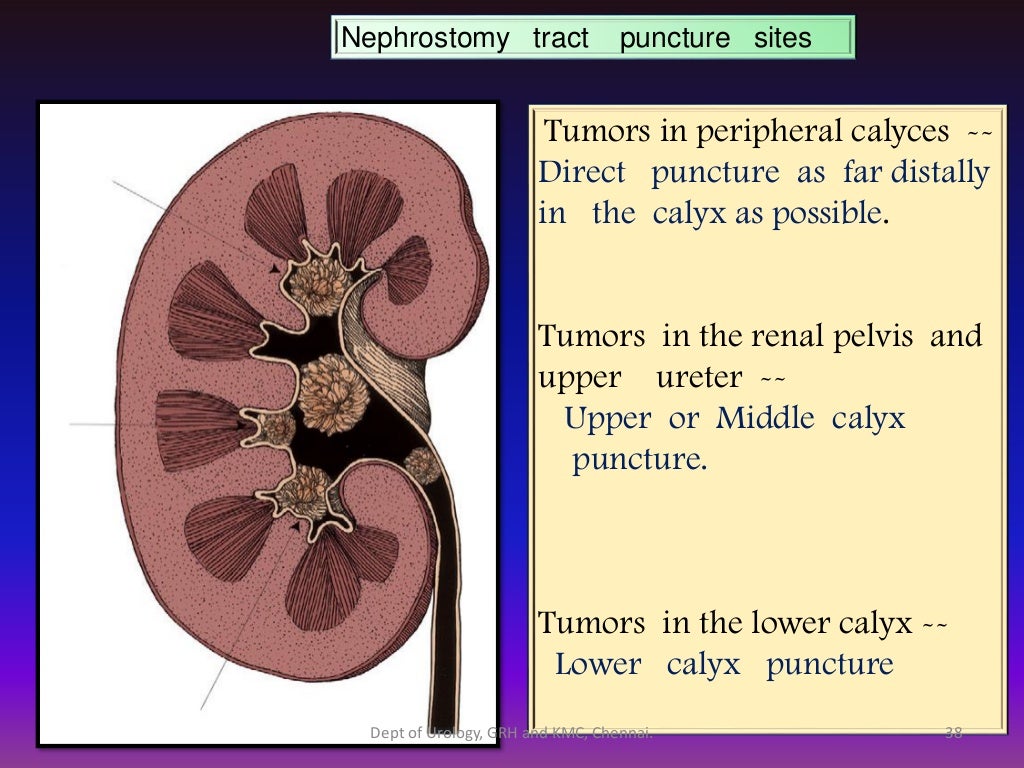 Upper urinary tract - Urothelial cell carcinoma