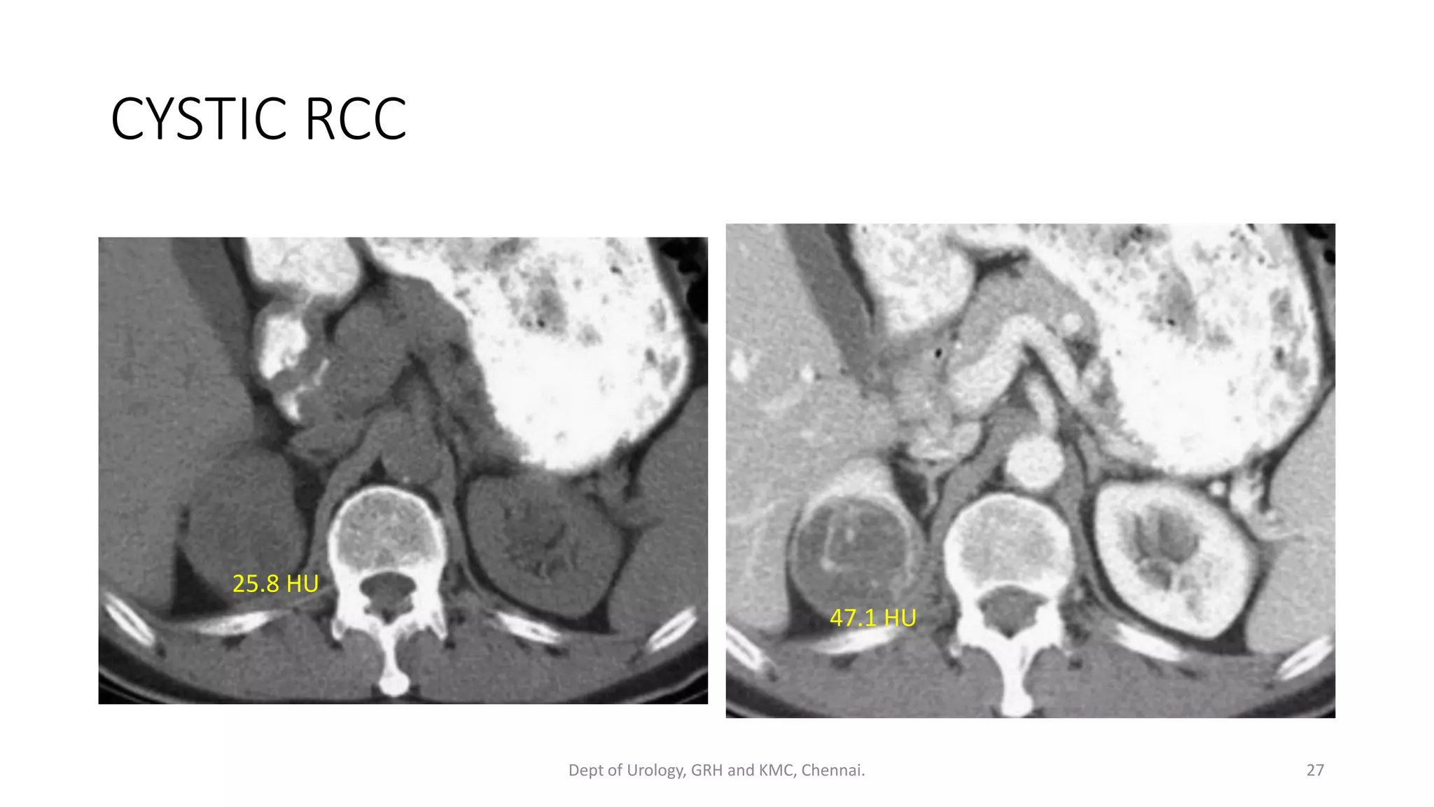 CLINICAL FEATURES & PROGNOSTIC FACTORS OF RCC | PPT