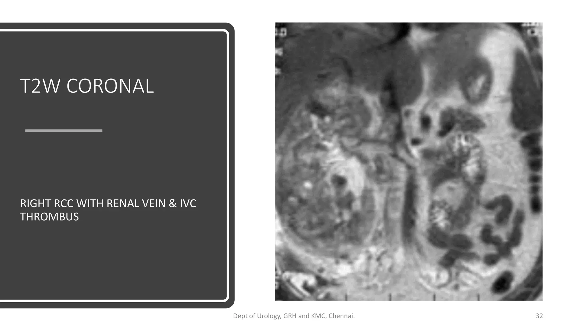 CLINICAL FEATURES & PROGNOSTIC FACTORS OF RCC | PPT