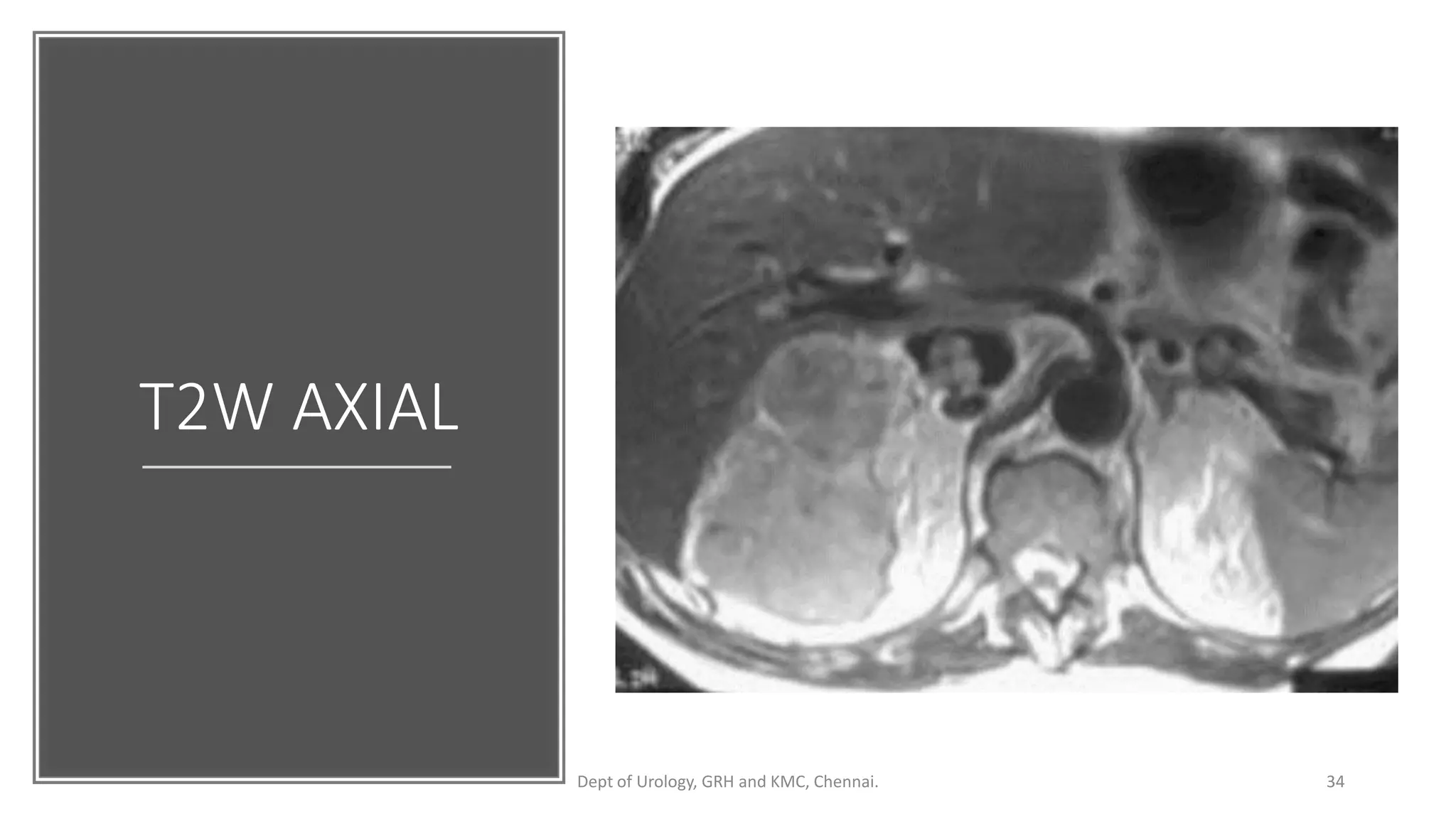 CLINICAL FEATURES & PROGNOSTIC FACTORS OF RCC | PPT