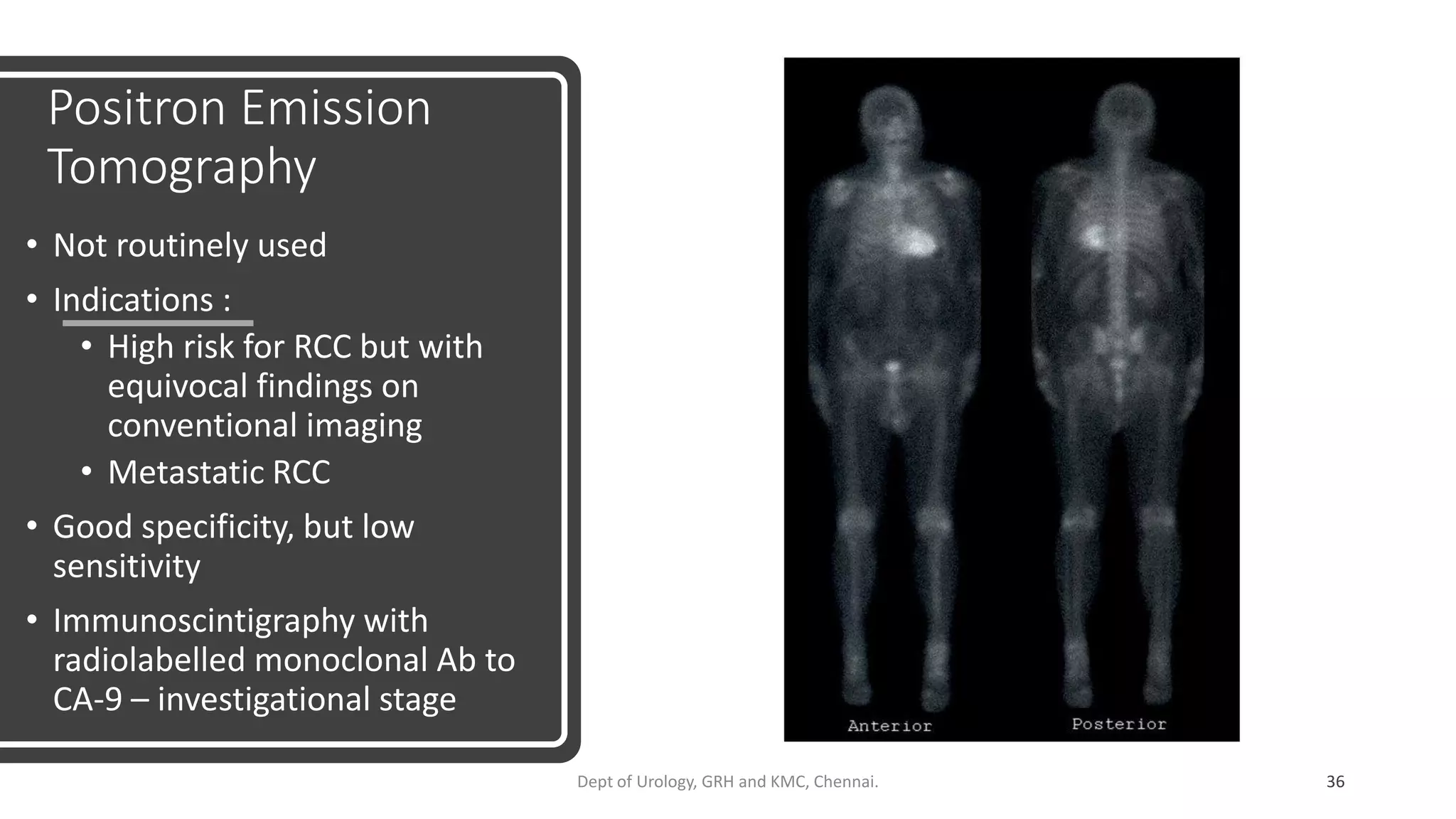 CLINICAL FEATURES & PROGNOSTIC FACTORS OF RCC | PPT