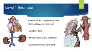 MANAGEMENT OF LOCALLY ADVANCED RENAL CELL CARCINOMA | PDF
