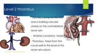 MANAGEMENT OF LOCALLY ADVANCED RENAL CELL CARCINOMA | PDF