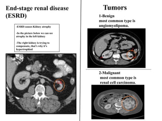 kidney information. Management morphology | PPTX