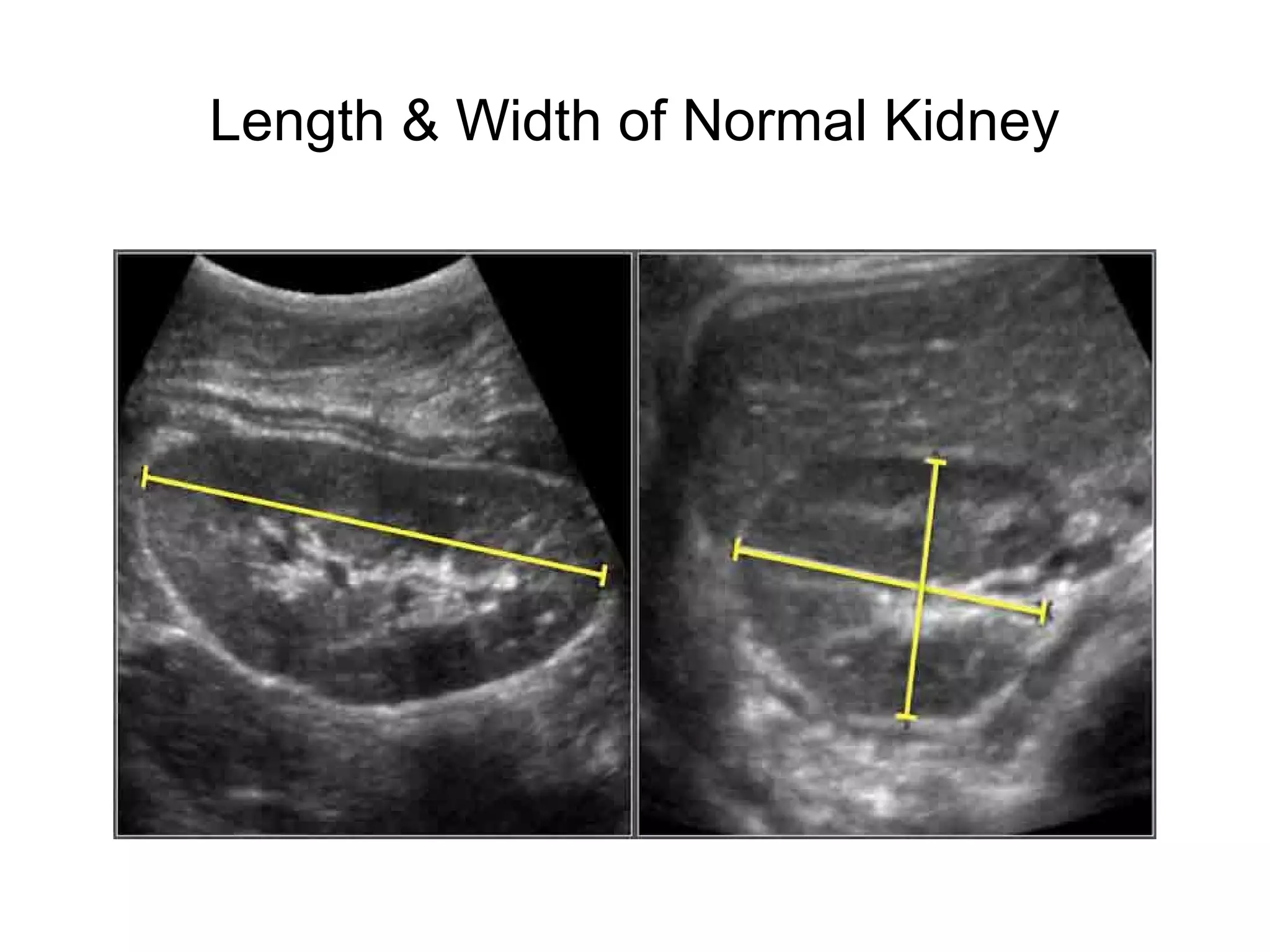 Kidney ultrasound | PPT | Medical Health