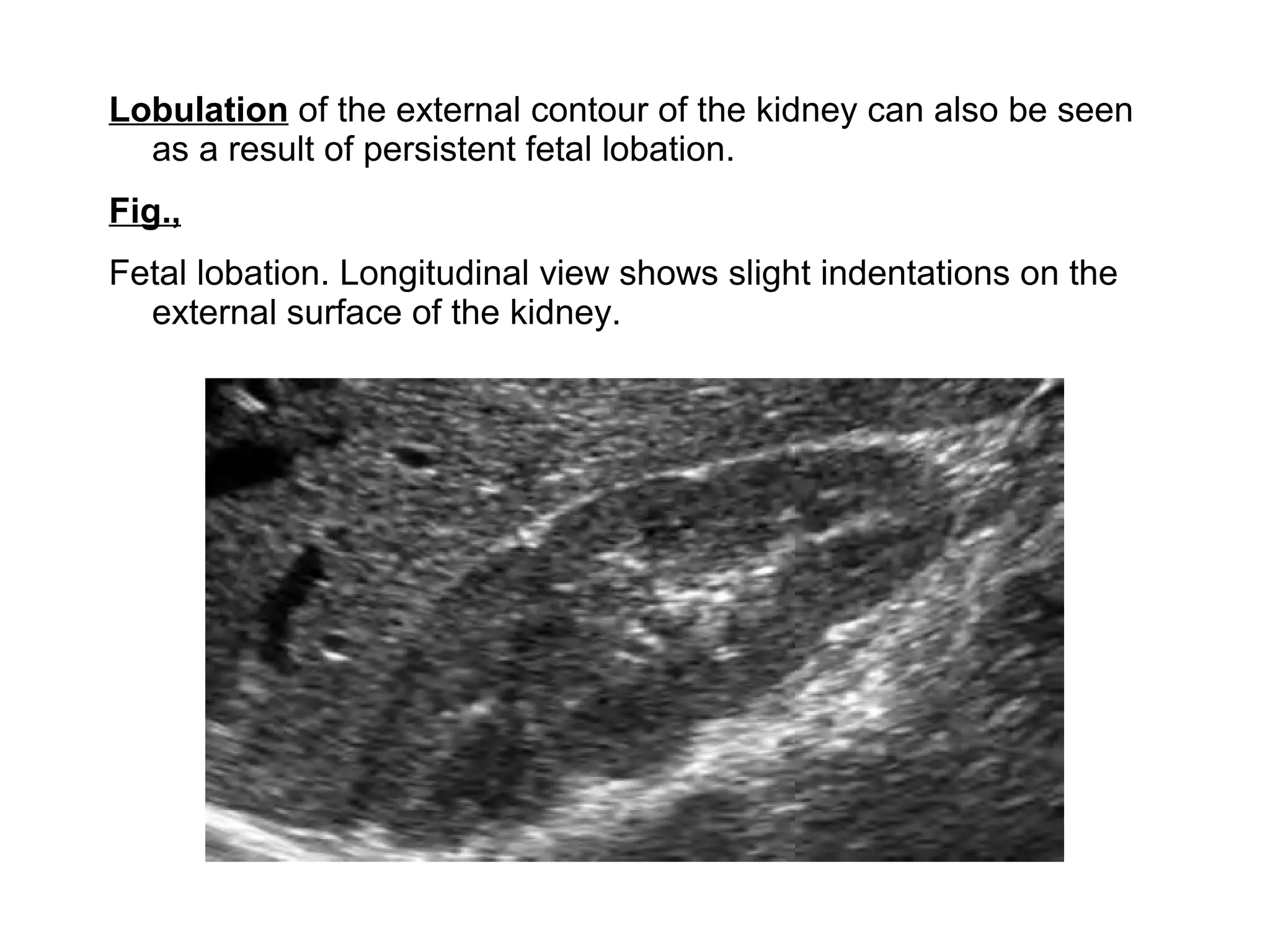 Kidney ultrasound | PPT