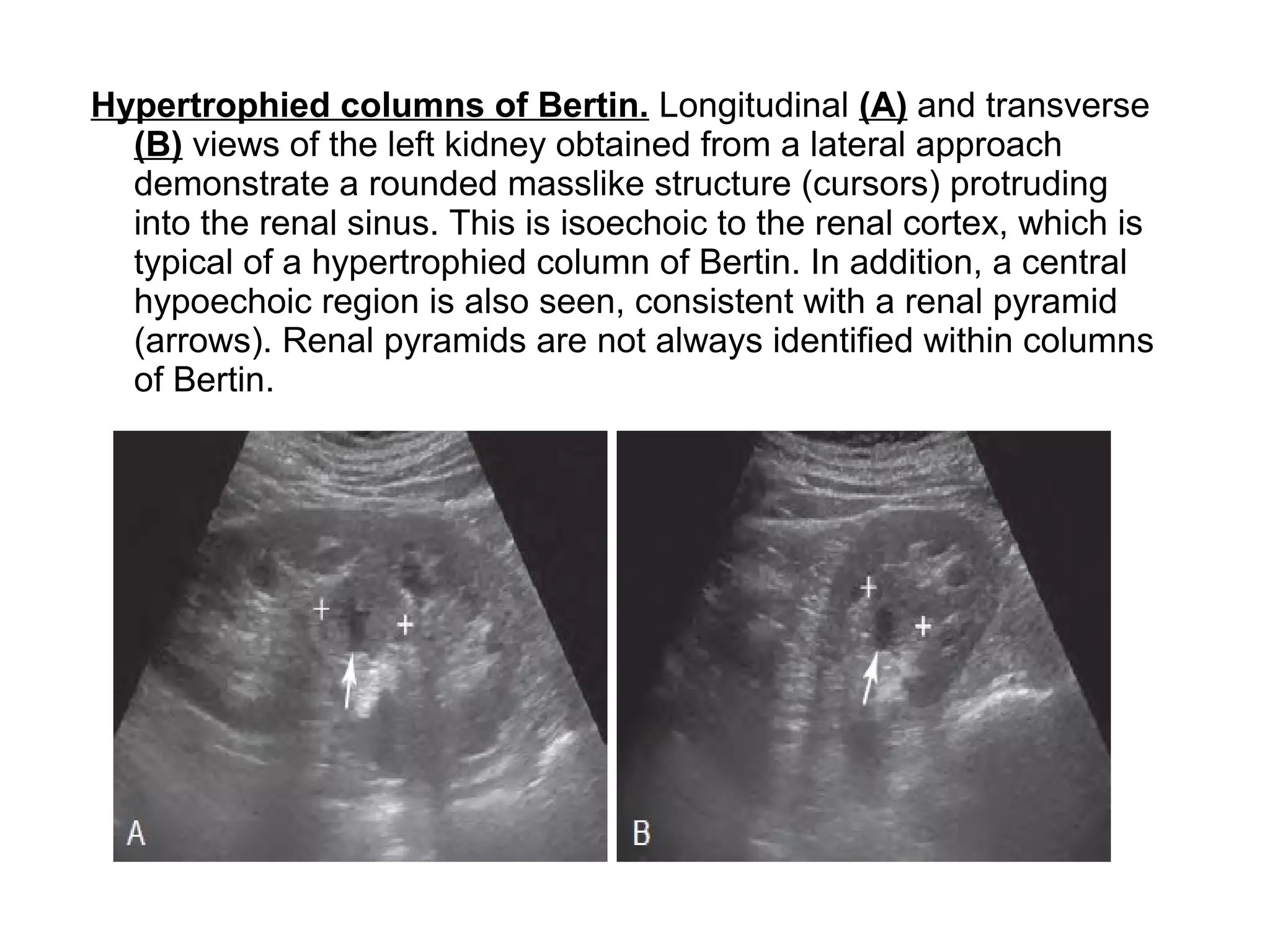 Kidney ultrasound | PPT