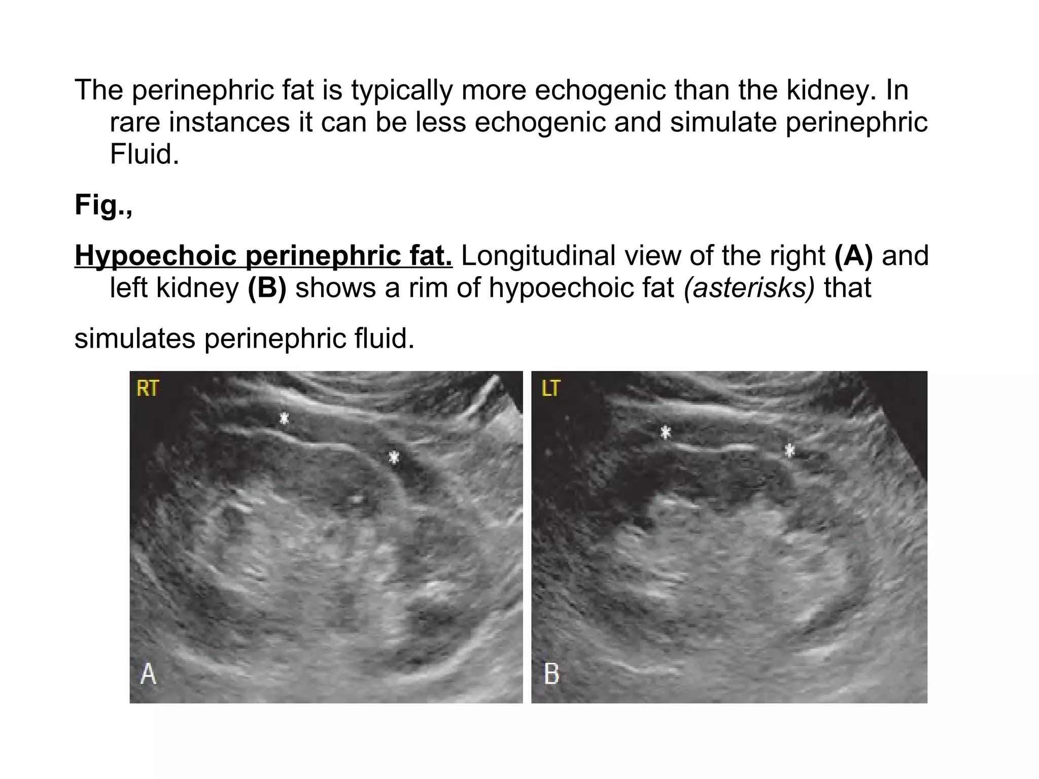 Kidney ultrasound | PPT