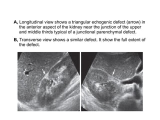 Junctional Parenchymal Defect
