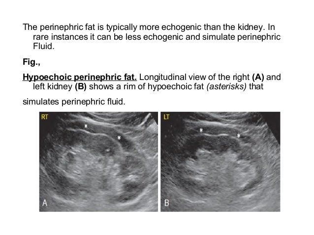 Kidney ultrasound