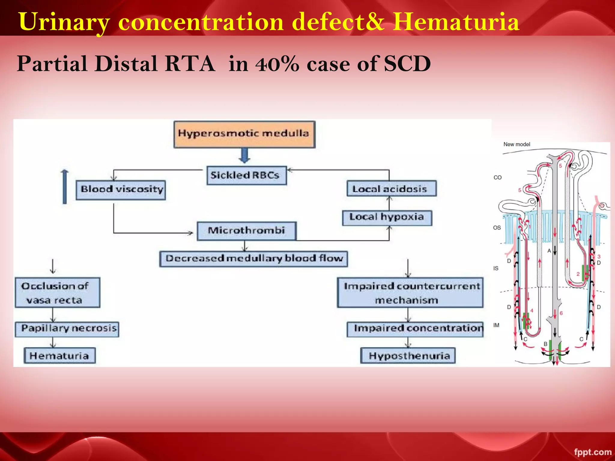 Kidney and scd | PPT