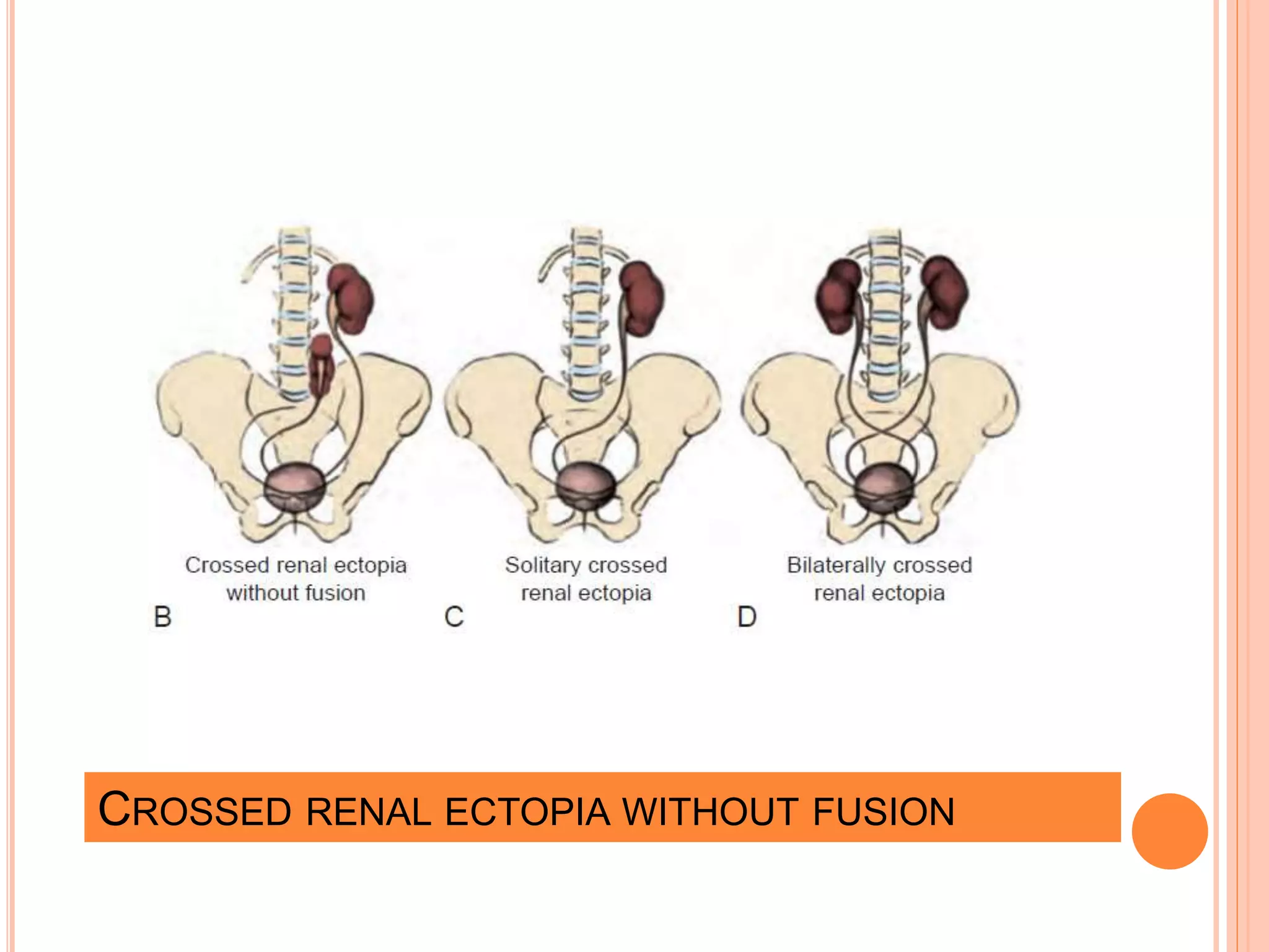 surgical anatomy of kidney and ureter | PPTX