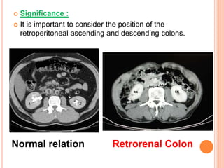 surgical anatomy of kidney and ureter | PPTX