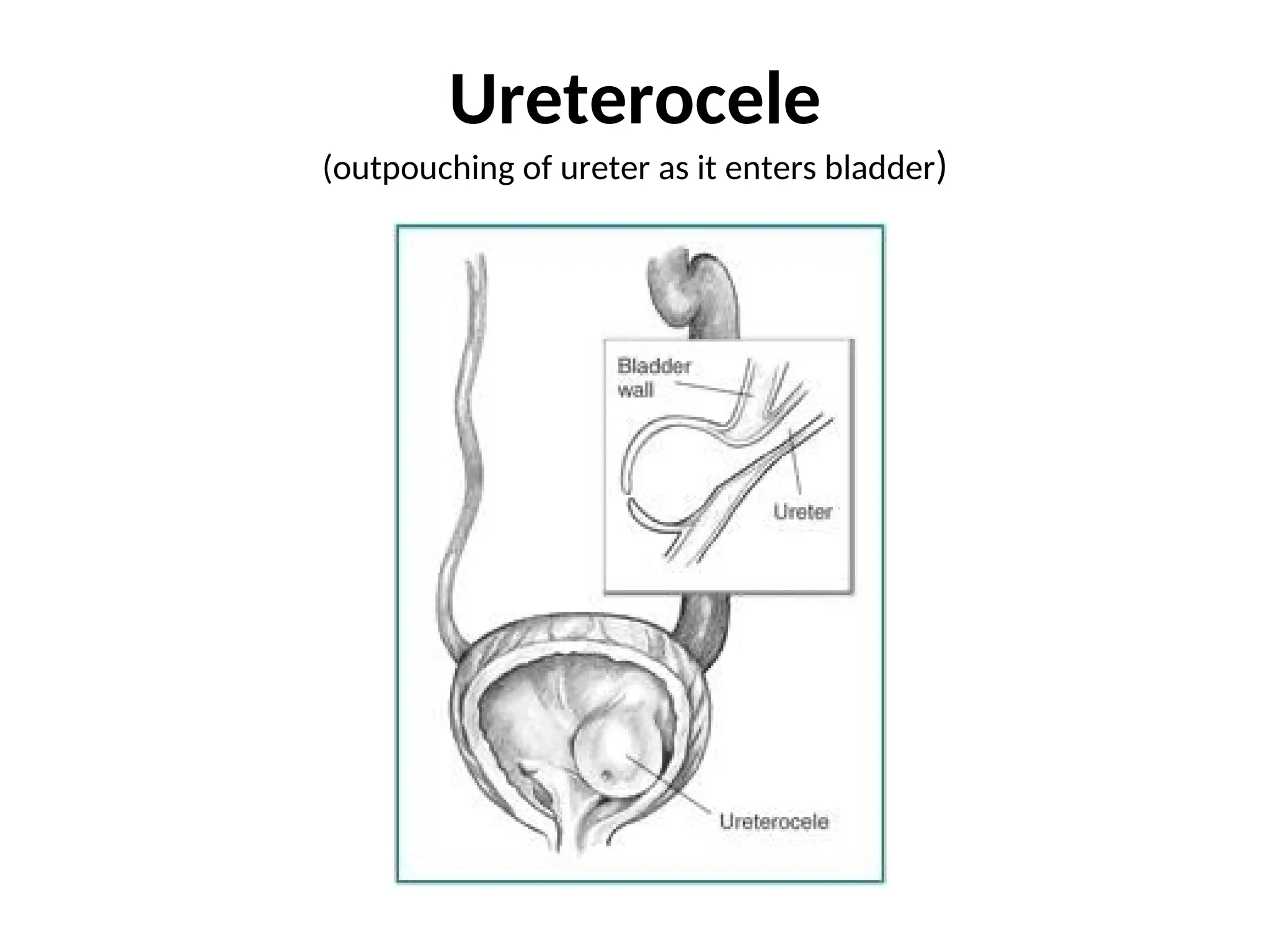 The kidney and The ureters Agenesis.ppt