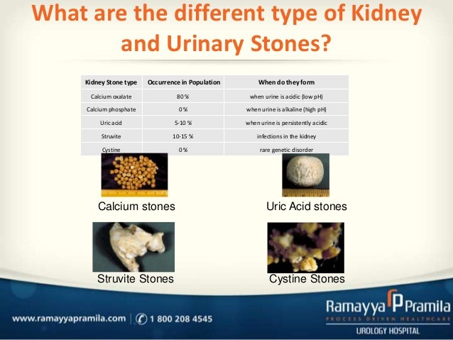 Urinary Tract Stones