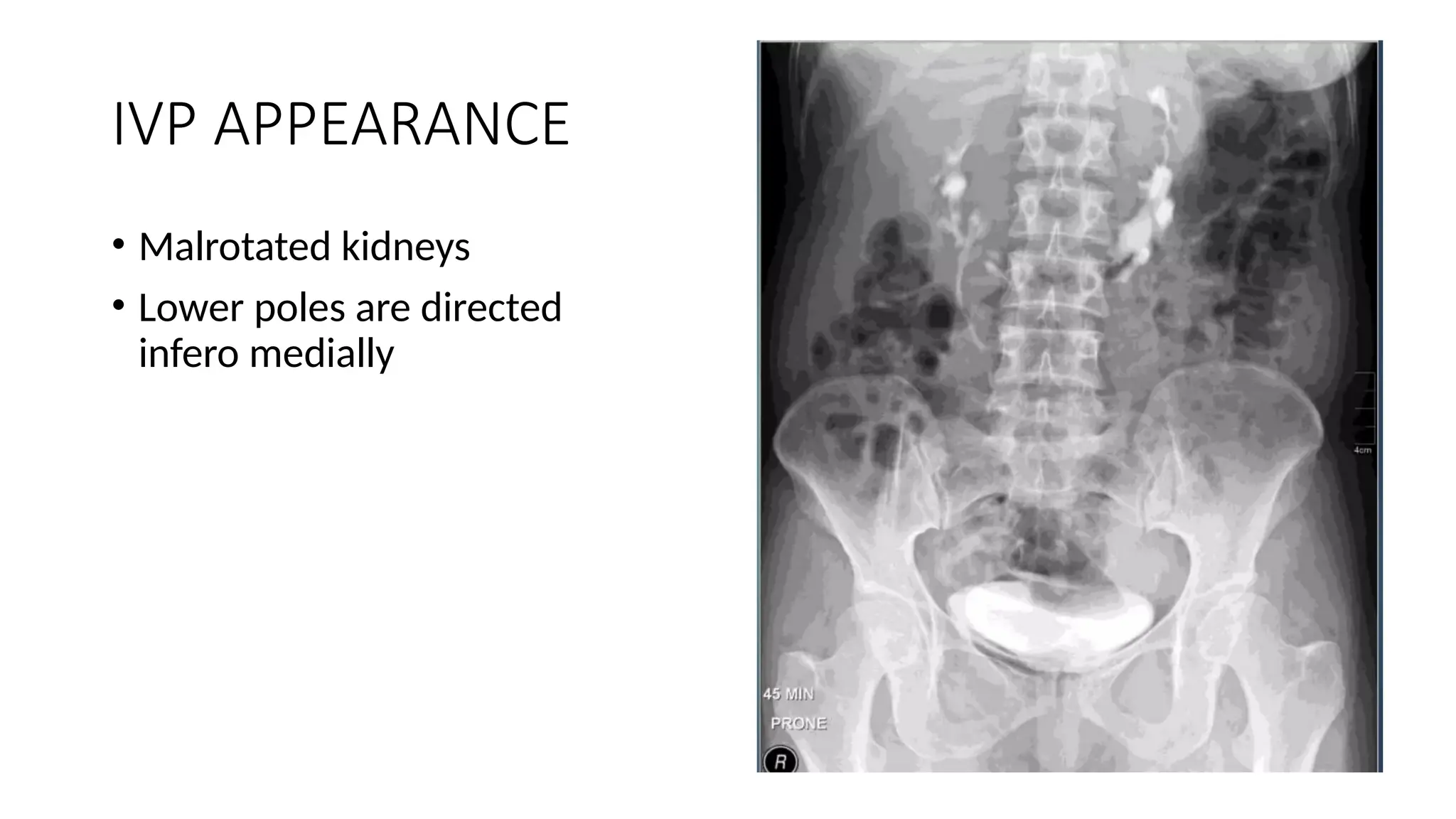 KIDNEY AND URINARY TRACT IMAGING AND FINDINGS | PPTX