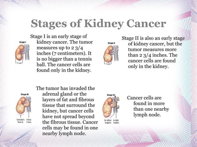 Kidney Cancer | PPT