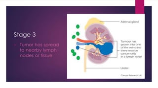 Kidney cancer | PPTX