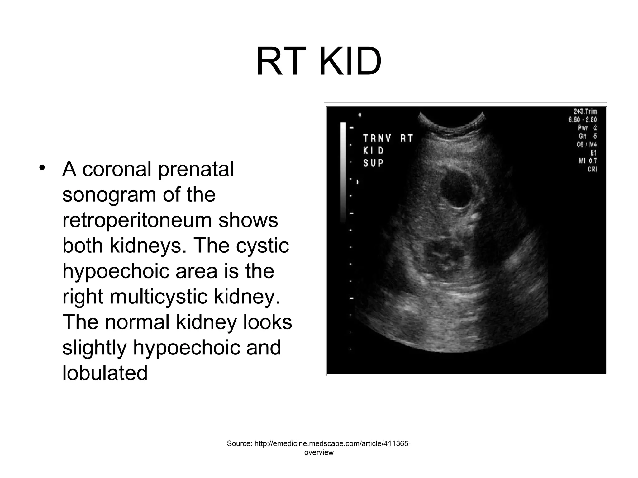 Kidney disease | PPT