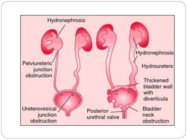 Kidney diseases and diuretics | PPTX | Blood Disorders | Diseases and ...