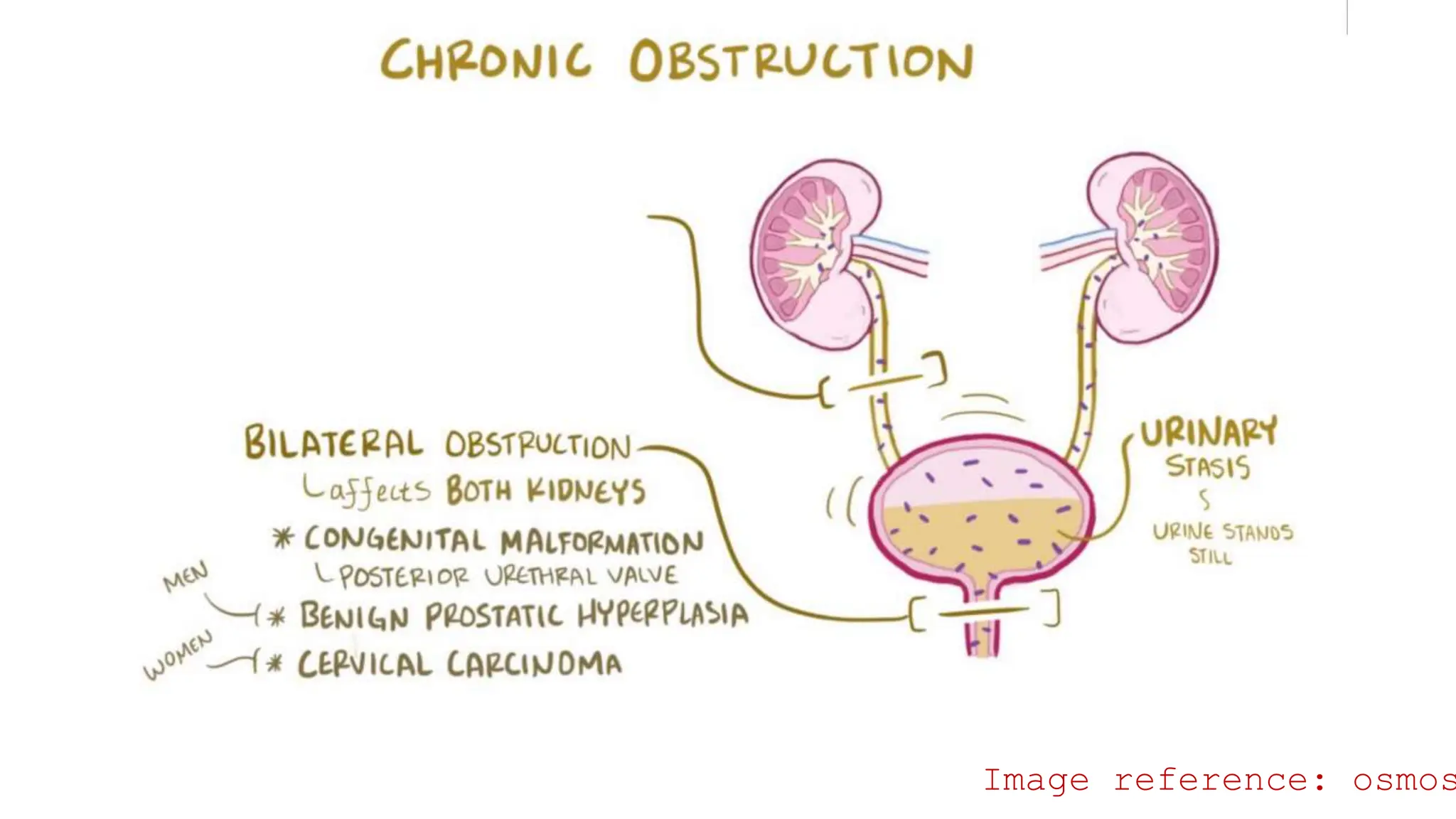 kidney infections(pyelonephritis)_surgery and medicine. | PPT