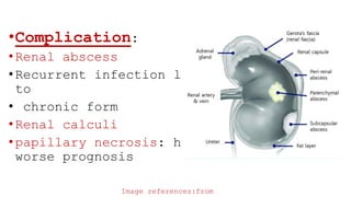 kidney infections(pyelonephritis)_surgery and medicine. | PPTX