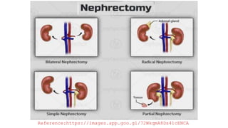 kidney infections(pyelonephritis)_surgery and medicine. | PPTX