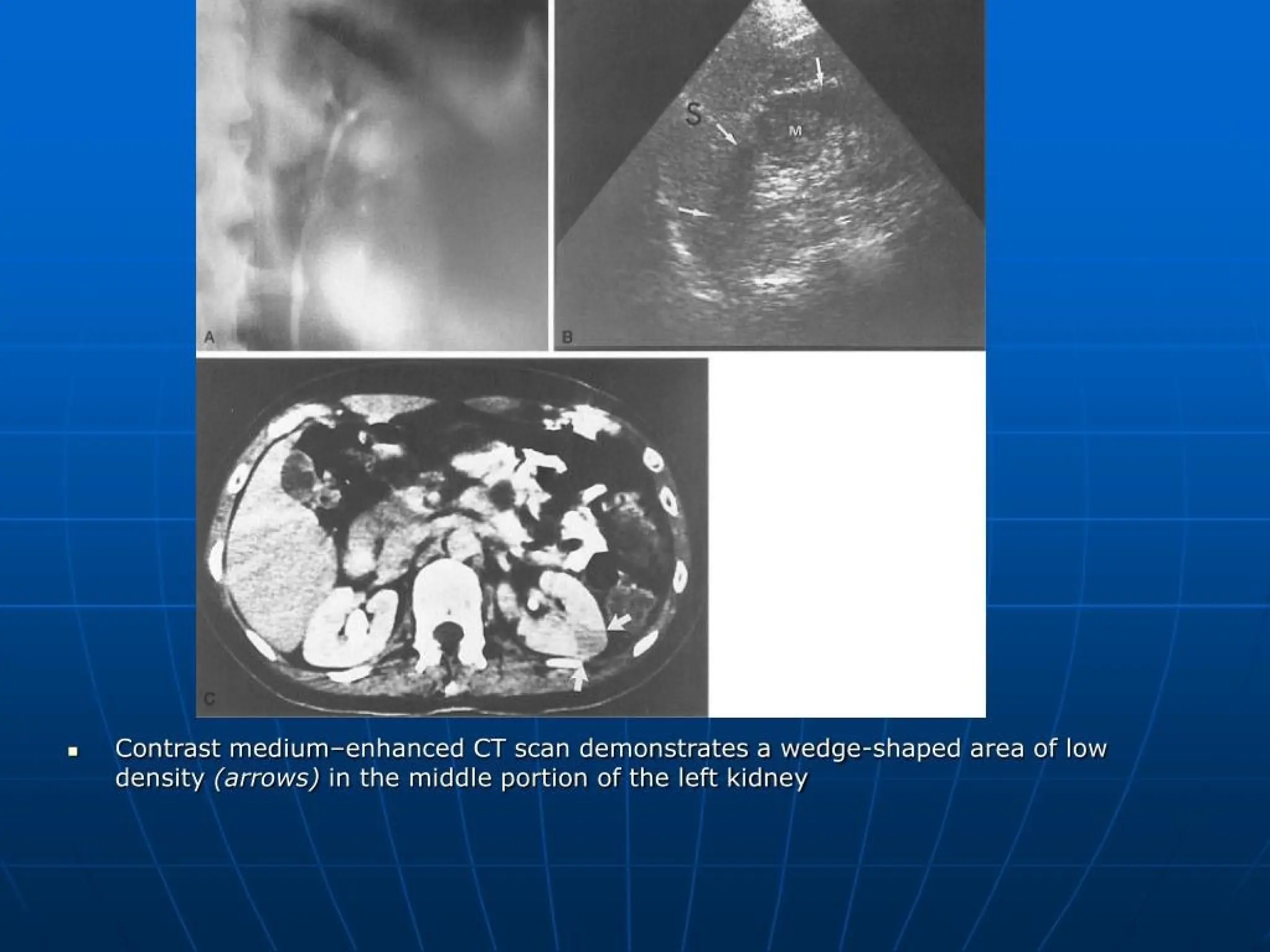 Kidney infections ppt.pdf acute and chronic...kidney abscess...renal ...