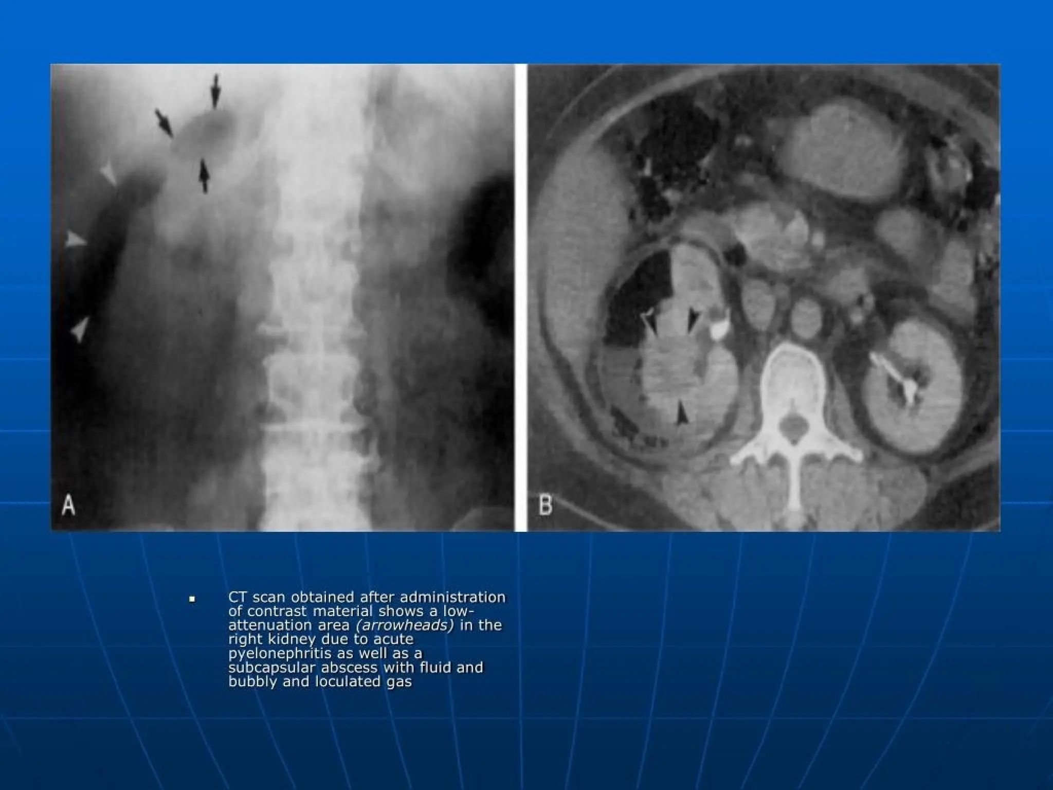 Kidney infections ppt.pdf acute and chronic...kidney abscess...renal ...