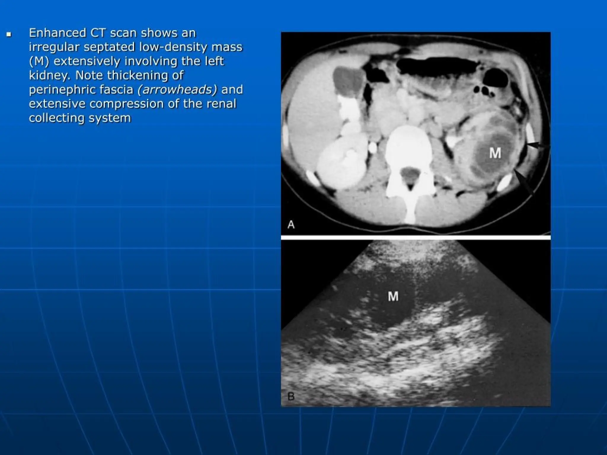 Kidney infections ppt.pdf acute and chronic...kidney abscess...renal ...