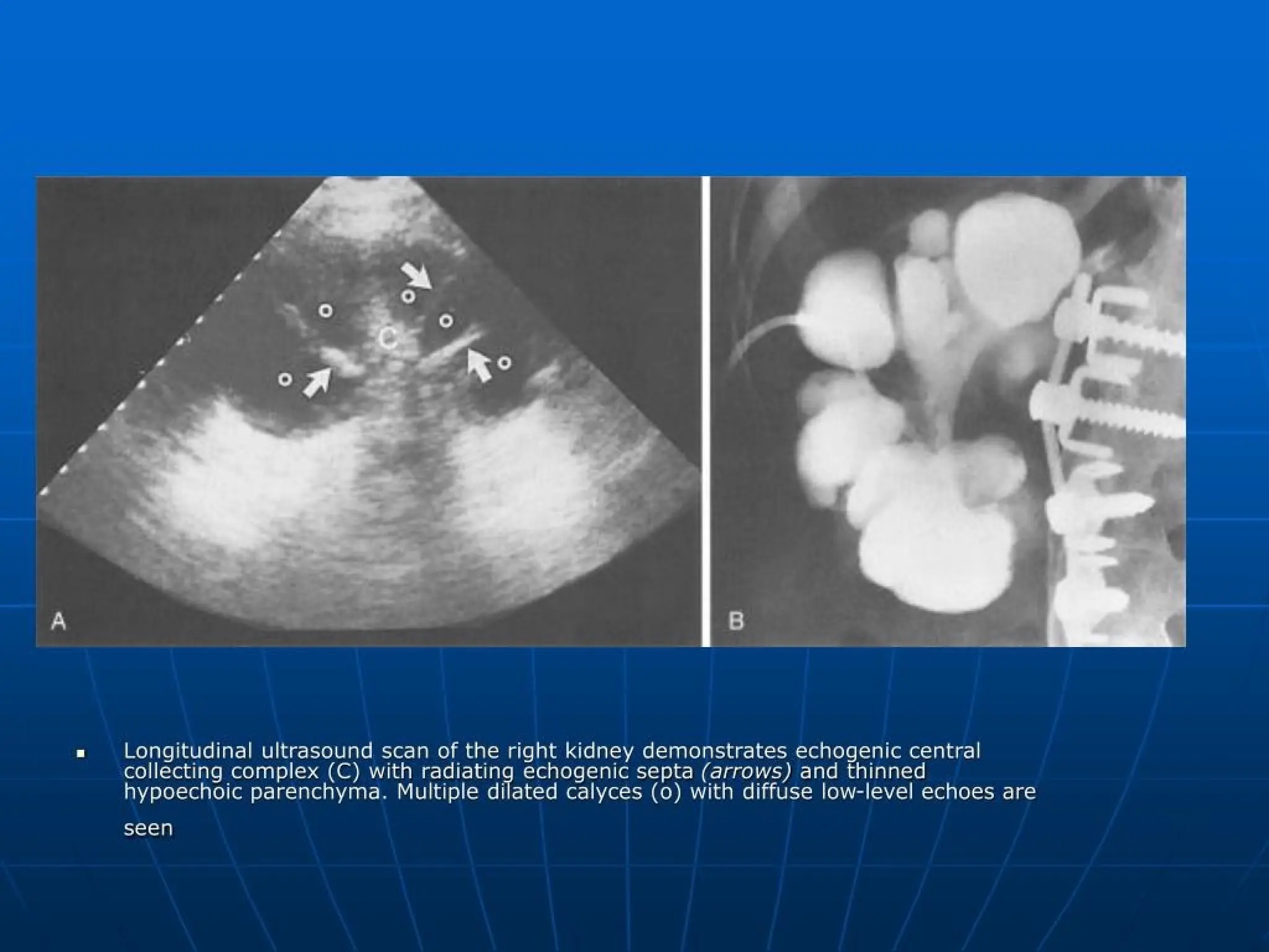 Kidney infections ppt.pdf acute and chronic...kidney abscess...renal ...