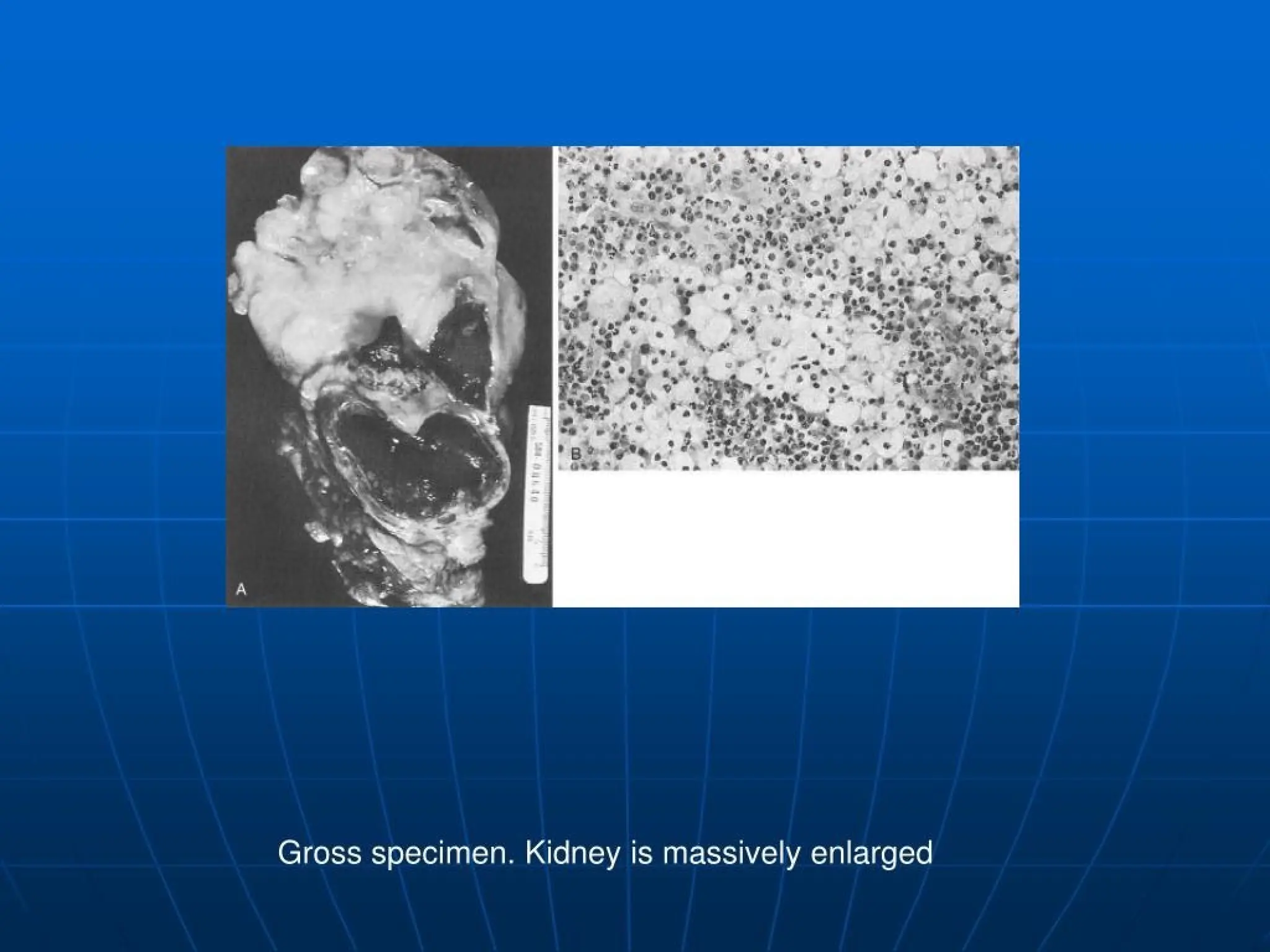 Kidney infections ppt.pdf acute and chronic...kidney abscess...renal ...
