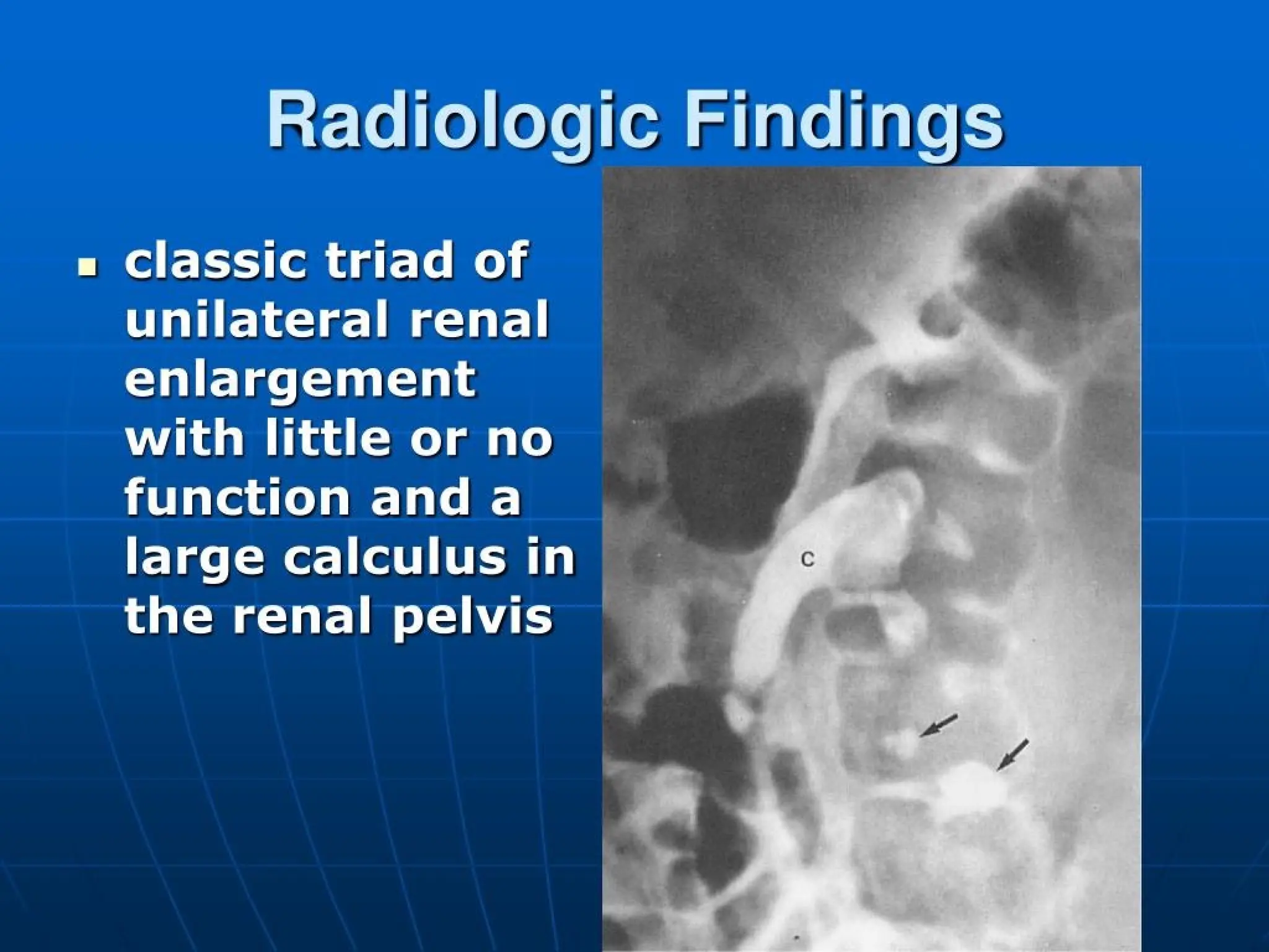 Kidney infections ppt.pdf acute and chronic...kidney abscess...renal ...
