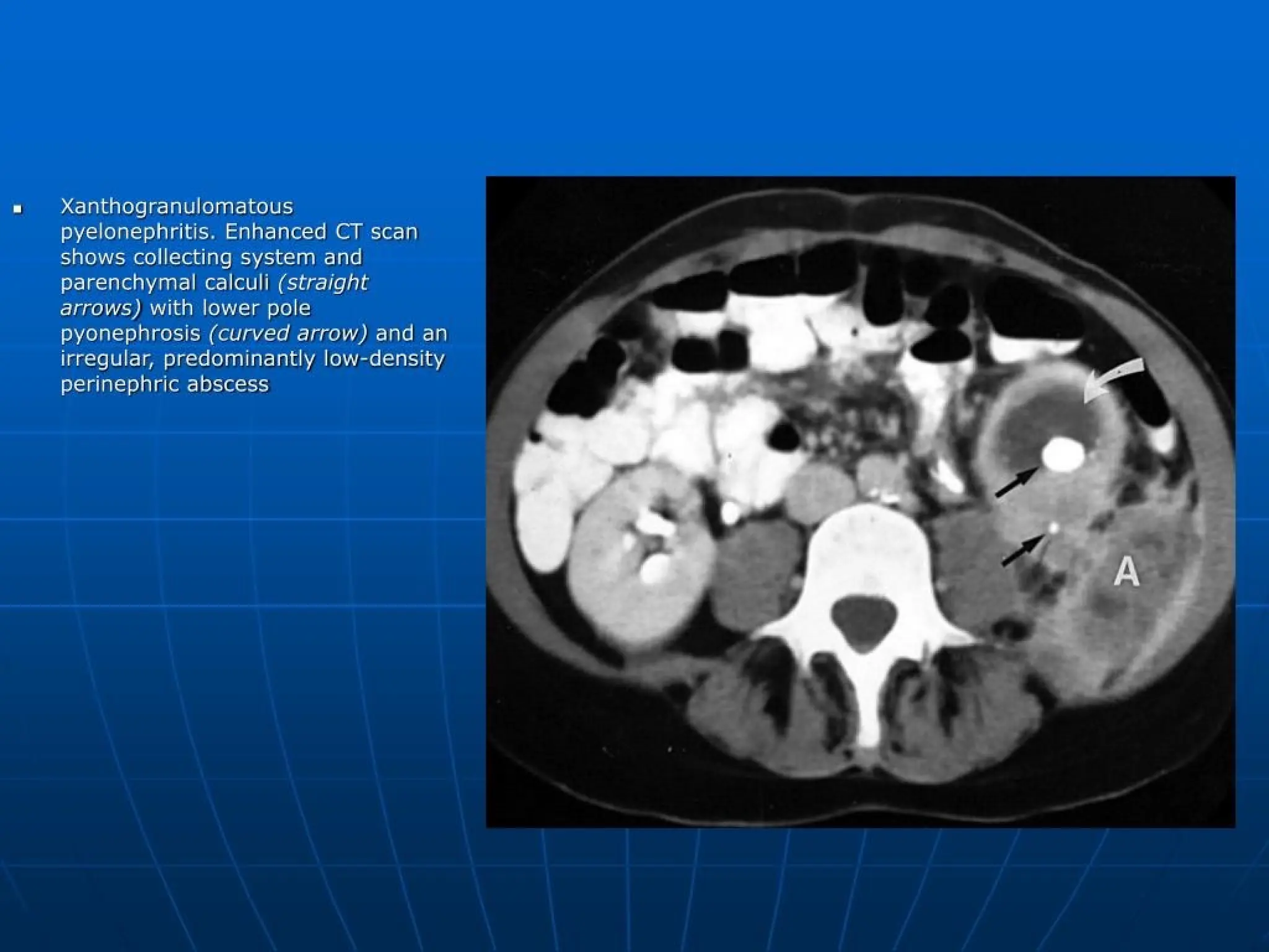 Kidney infections ppt.pdf acute and chronic...kidney abscess...renal ...